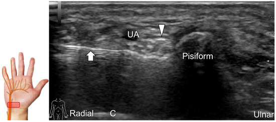Ultrasound Imaging and Guidance for Distal Peripheral Nerve Pathologies ...