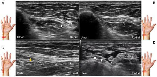 Ultrasound Imaging and Guidance for Distal Peripheral Nerve Pathologies ...