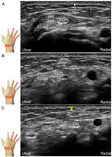 Ultrasound Imaging and Guidance for Distal Peripheral Nerve Pathologies ...