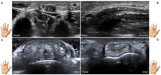 Ultrasound Imaging and Guidance for Distal Peripheral Nerve Pathologies ...
