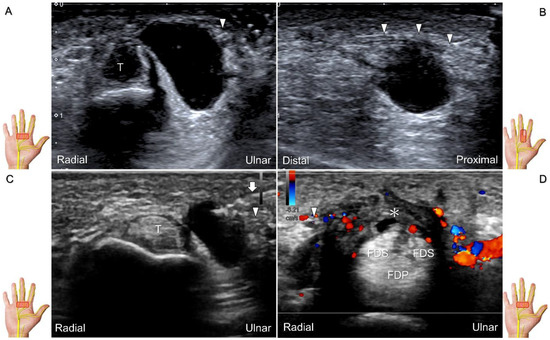 Ultrasound Imaging and Guidance for Distal Peripheral Nerve Pathologies ...