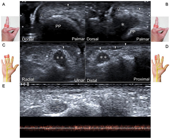 Ultrasound Imaging and Guidance for Distal Peripheral Nerve Pathologies ...