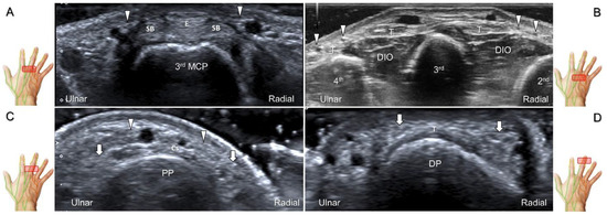 Ultrasound Imaging and Guidance for Distal Peripheral Nerve Pathologies ...