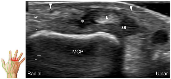 Ultrasound Imaging and Guidance for Distal Peripheral Nerve Pathologies ...