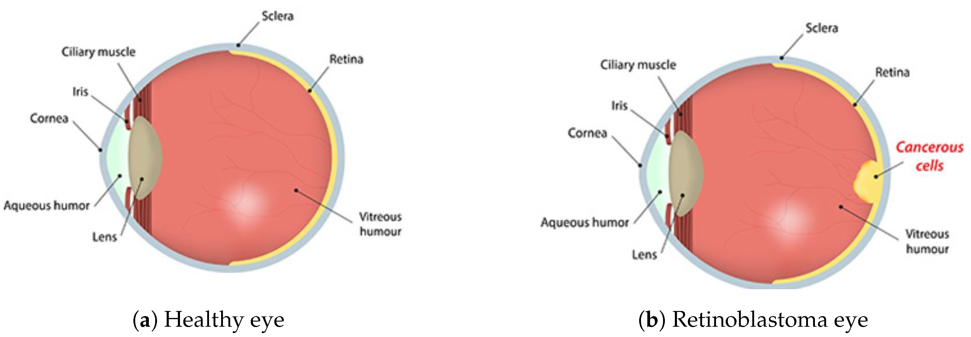 Diagnostics | Free Full-Text | Explainable AI for Retinoblastoma Diagnosis: Interpreting Deep ...