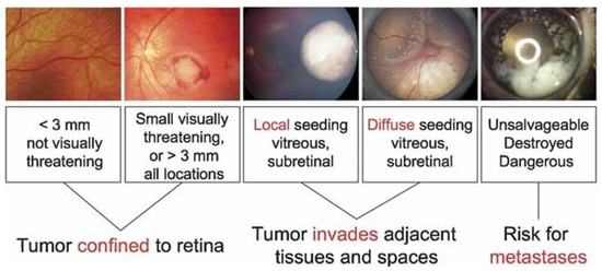 Explainable AI for Retinoblastoma Diagnosis: Interpreting Deep Learning ...