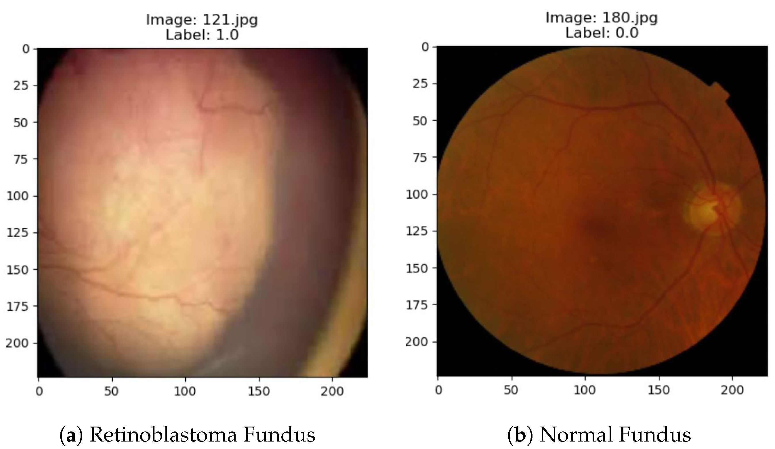 Explainable AI for Retinoblastoma Diagnosis: Interpreting Deep Learning ...