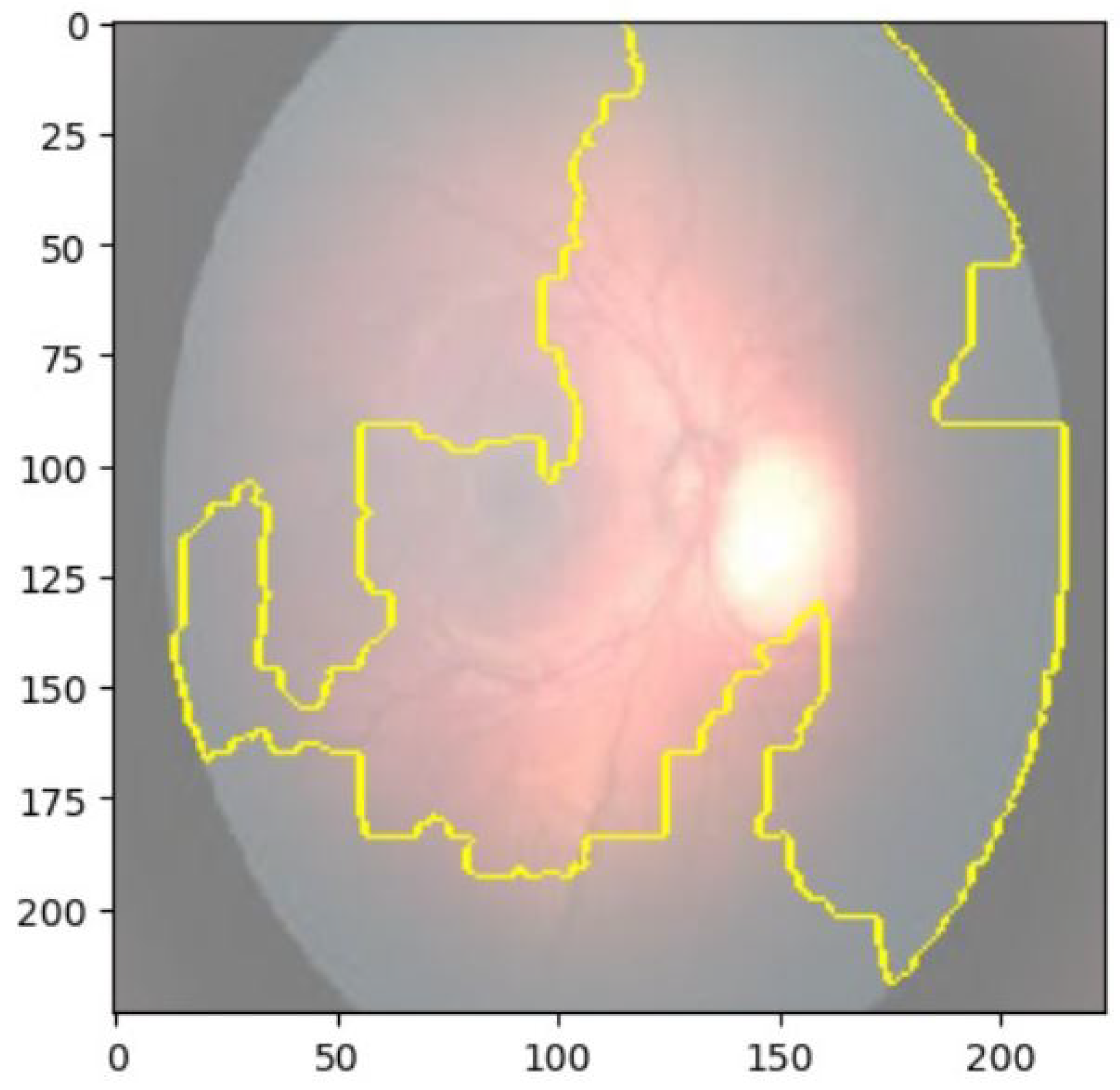 Explainable AI for Retinoblastoma Diagnosis: Interpreting Deep Learning ...