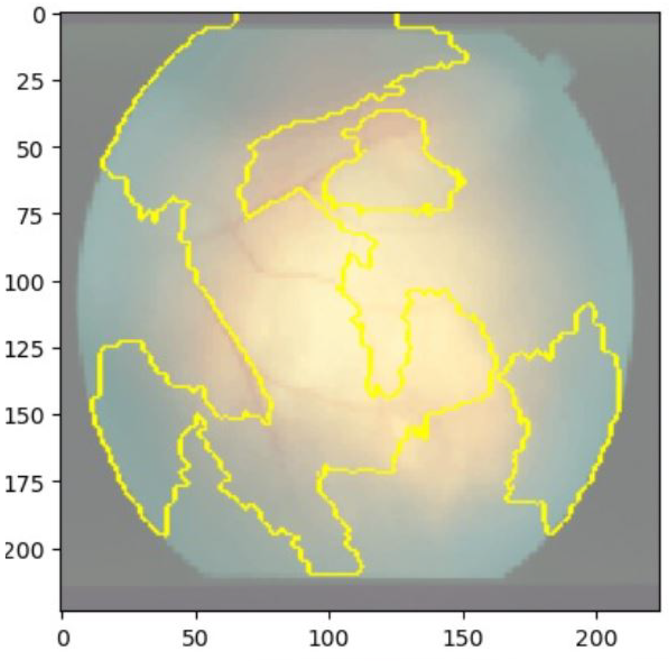 Explainable AI for Retinoblastoma Diagnosis: Interpreting Deep Learning ...