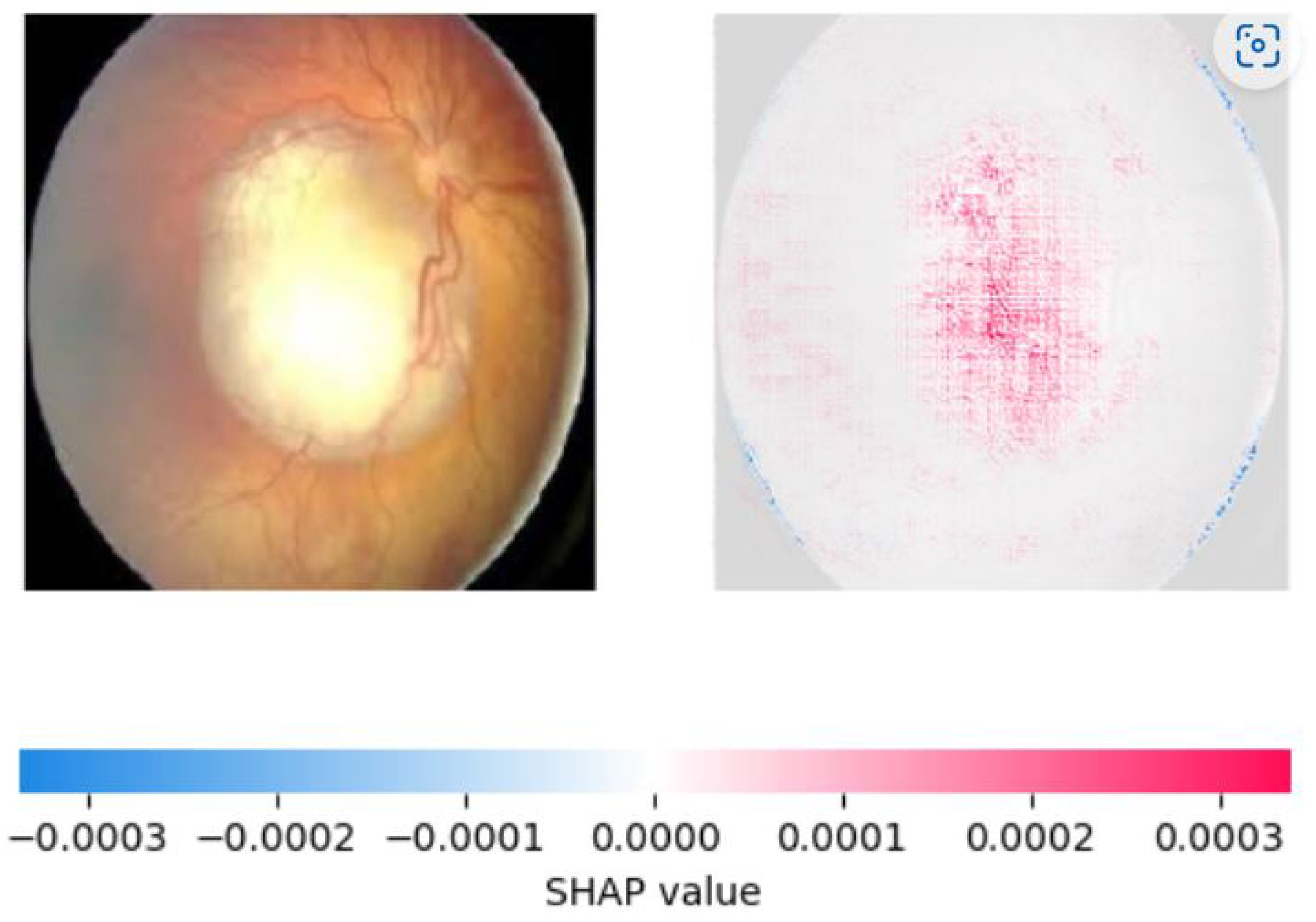 Explainable AI for Retinoblastoma Diagnosis: Interpreting Deep Learning Models with LIME and SHAP