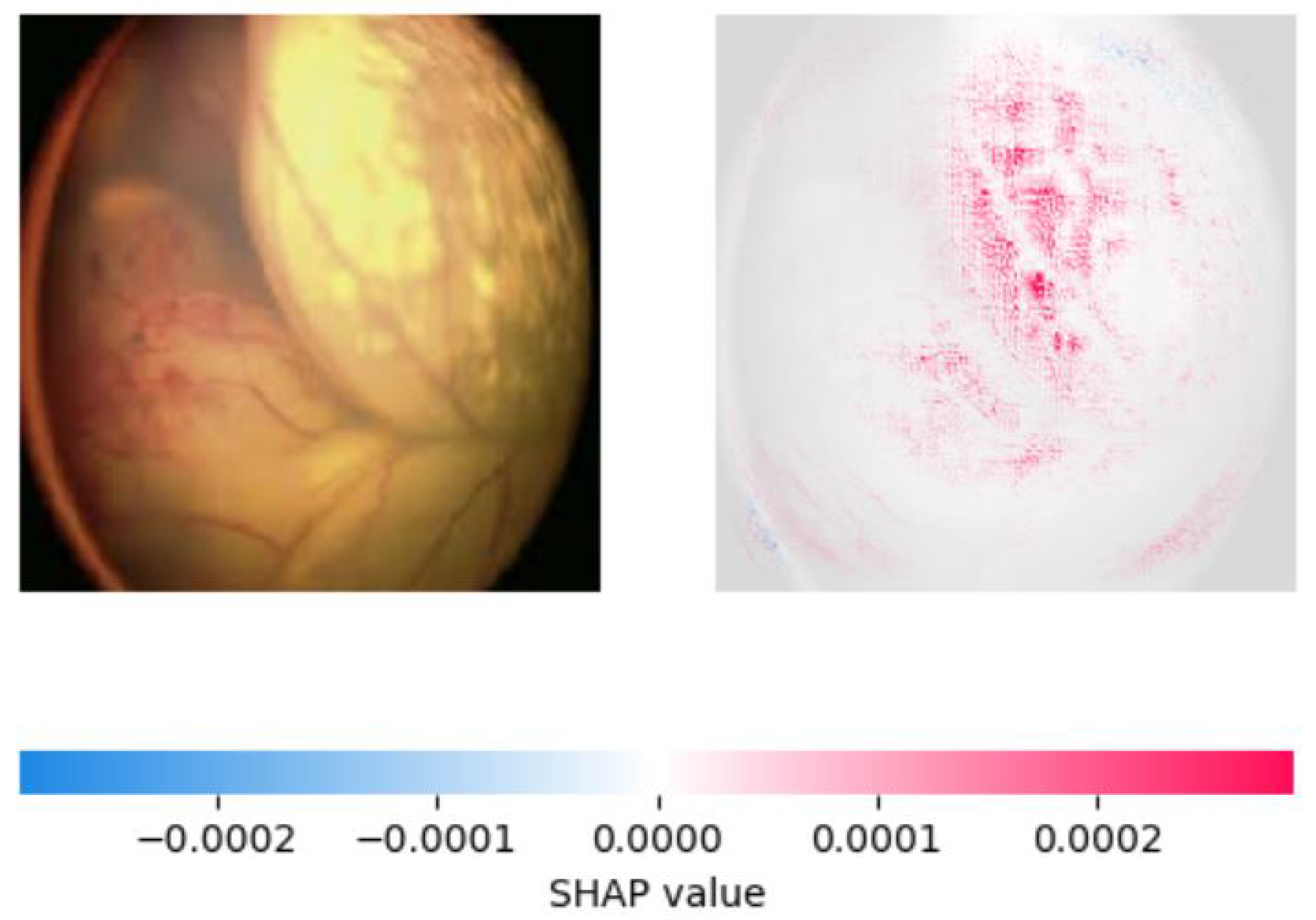 Explainable AI for Retinoblastoma Diagnosis: Interpreting Deep Learning ...