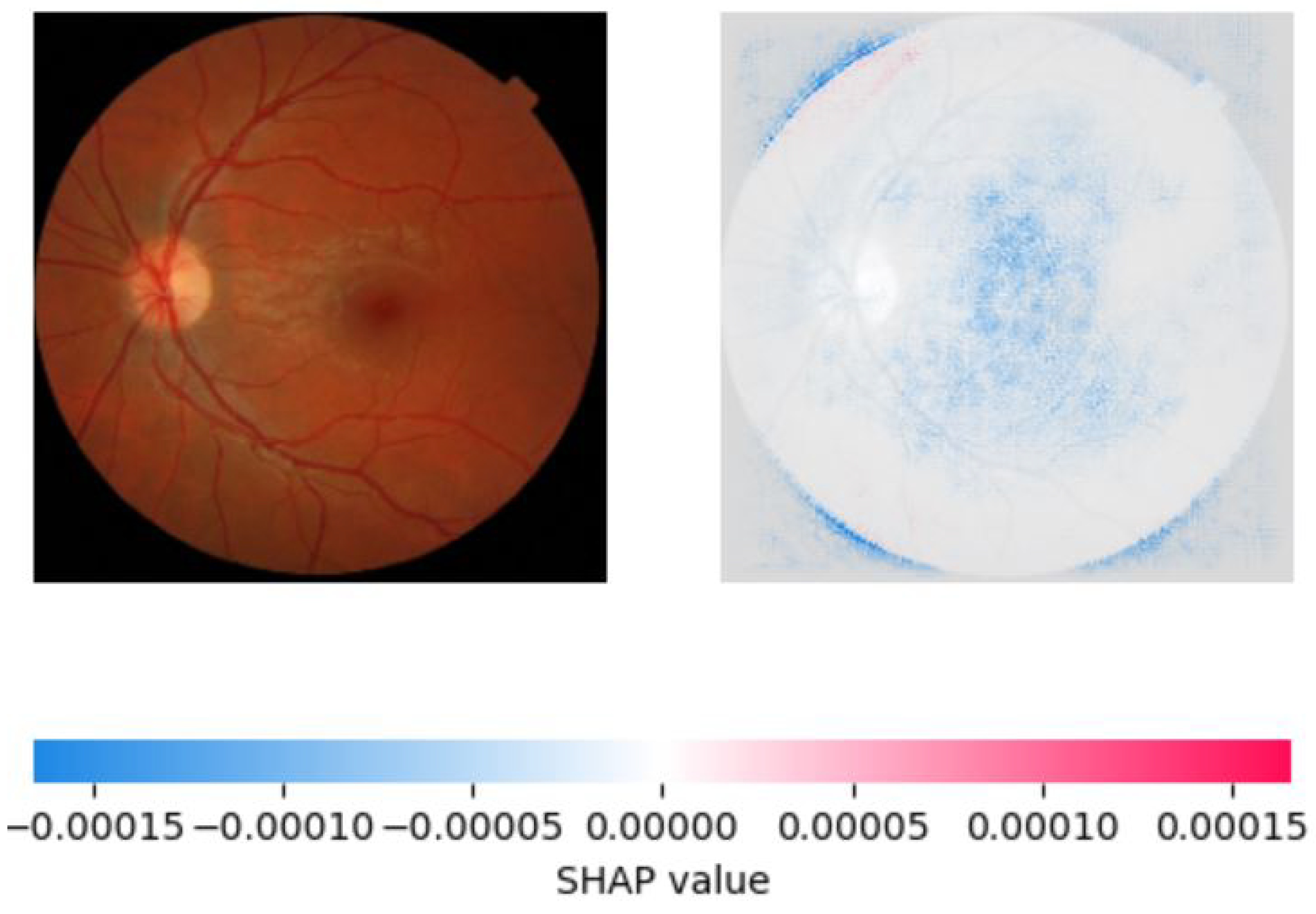 Explainable AI for Retinoblastoma Diagnosis: Interpreting Deep Learning ...
