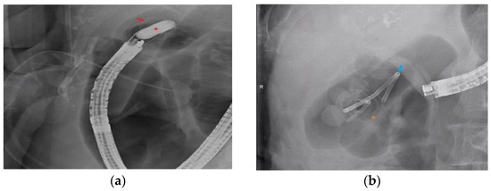 Endoscopic Ultrasound-Guided Gallbladder Drainage: Beyond Cholecystitis
