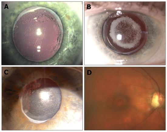 Clinical Characteristics of Patients with Intraocular Lens ...