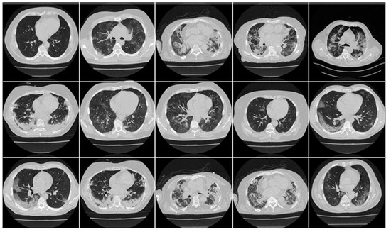 Ensemble Deep Learning Derived from Transfer Learning for ...