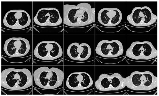 Ensemble Deep Learning Derived from Transfer Learning for Classification of COVID-19 Patients on ...