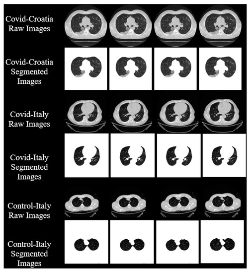 Ensemble Deep Learning Derived from Transfer Learning for Classification of COVID-19 Patients on ...