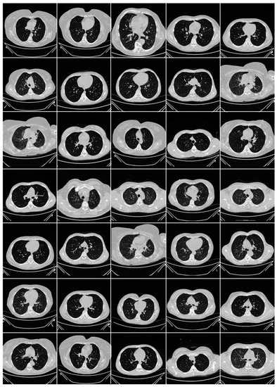 Ensemble Deep Learning Derived from Transfer Learning for ...