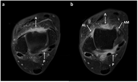 Fluid-Attenuated Inversion Recovery Sequence with Fat Suppression for ...