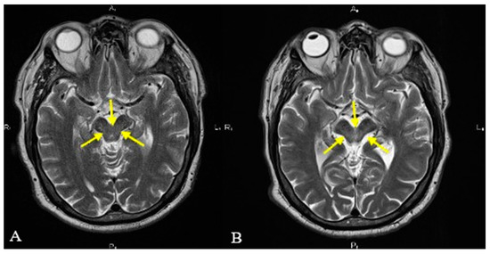 Imaging Criteria for the Diagnosis of Progressive Supranuclear Palsy ...