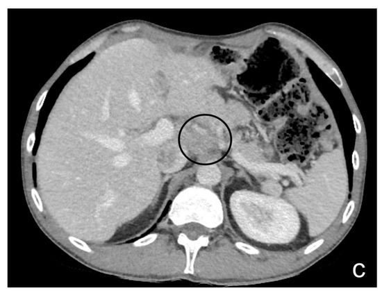Peritoneal Carcinosis: What the Radiologist Needs to Know