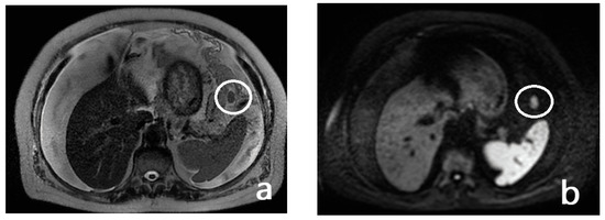 Peritoneal Carcinosis: What the Radiologist Needs to Know