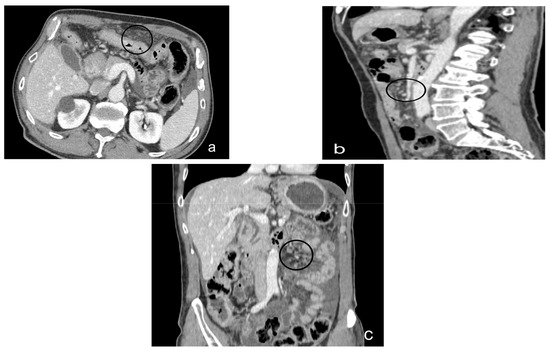 Peritoneal Carcinosis: What the Radiologist Needs to Know
