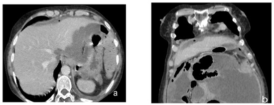 Peritoneal Carcinosis: What the Radiologist Needs to Know