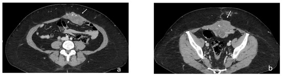 Peritoneal Carcinosis: What the Radiologist Needs to Know