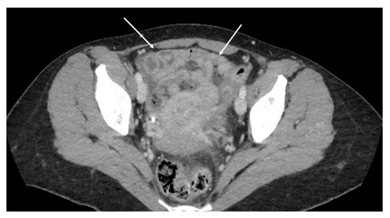 Peritoneal Carcinosis: What the Radiologist Needs to Know