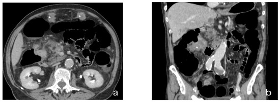 Peritoneal Carcinosis: What the Radiologist Needs to Know