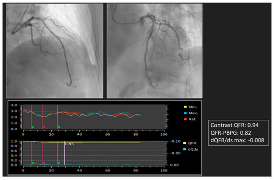 Coronary Angiography Upgraded by Imaging Post-Processing: Present and ...