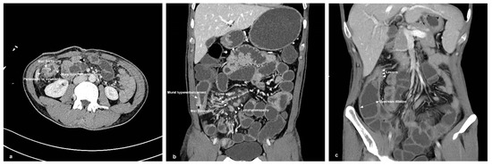 Retrospective Cohort Study of Shear-Wave Elastography and Computed ...