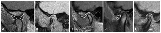 High-Field Magnetic Resonance Imaging of the Temporomandibular Joint ...