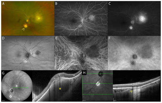 Optical Coherence Tomography in Inflammatory and Neoplastic Lesions ...