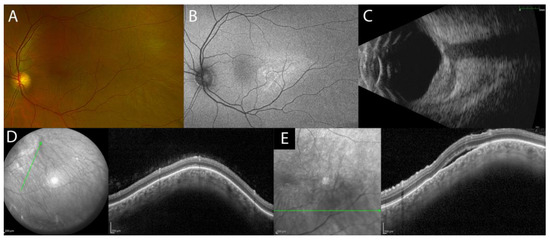 Optical Coherence Tomography in Inflammatory and Neoplastic Lesions ...