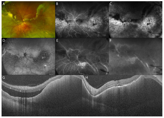 Optical Coherence Tomography in Inflammatory and Neoplastic Lesions ...