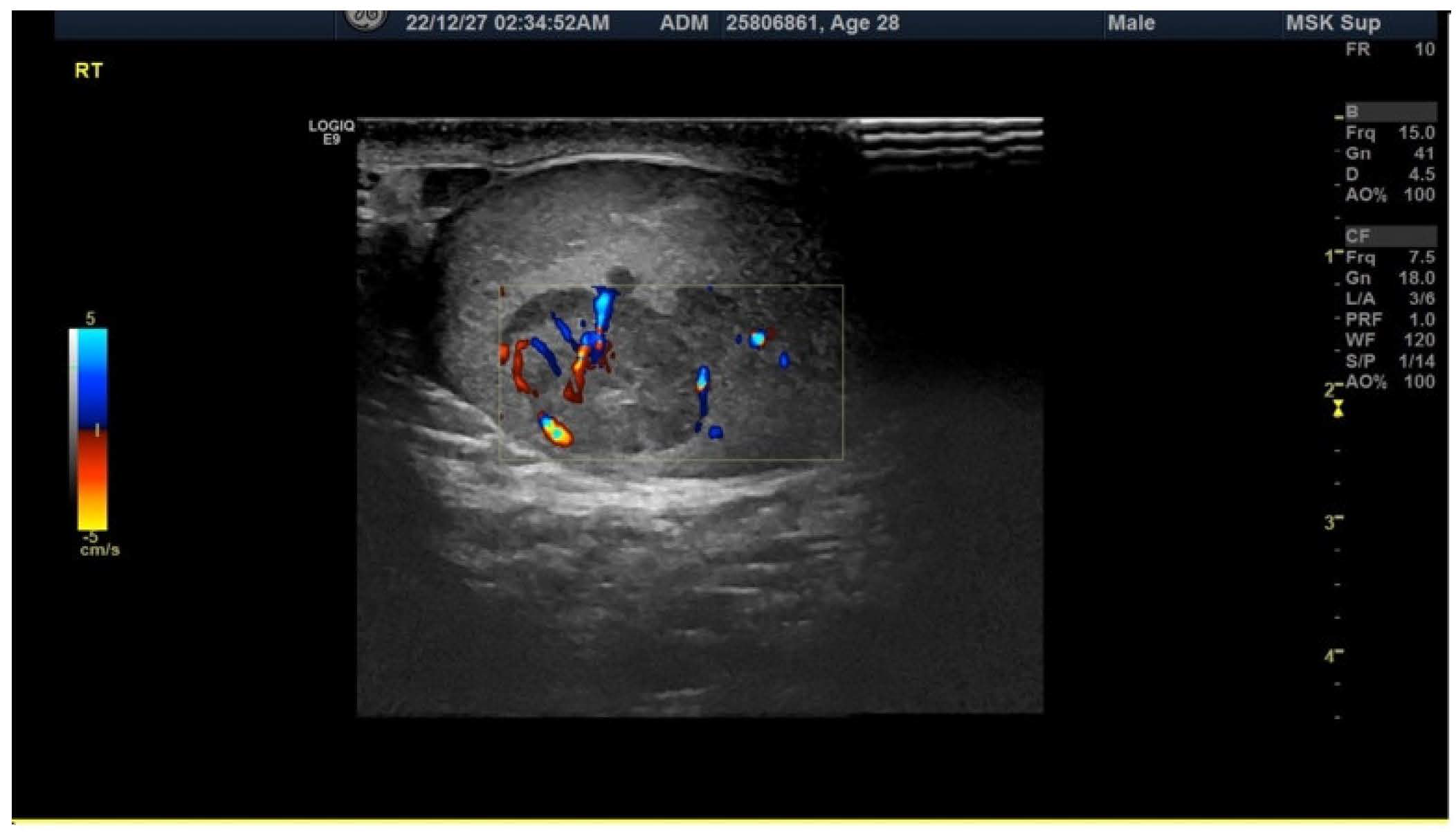 Intratesticular Hematoma In A Patient With Continued
