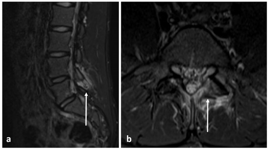 Diagnostics | Free Full-Text | Primary Benign Neoplasms of the Spine