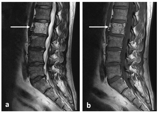 Aneurysmal Bone Cyst Spine Mri