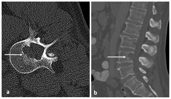Diagnostics | Free Full-Text | Primary Benign Neoplasms of the Spine