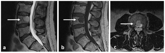 Primary Benign Neoplasms of the Spine