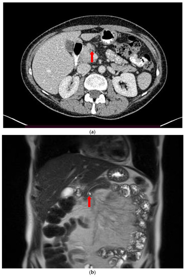 Intraductal Papillary Mucinous Neoplasm of the Pancreas: A Challenging ...