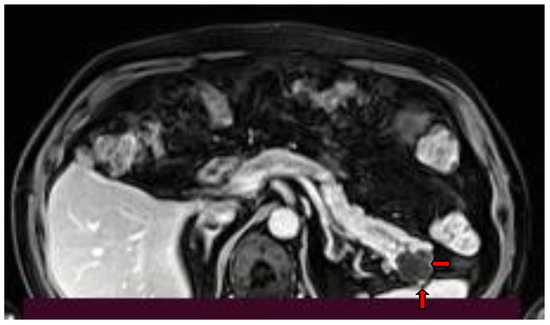 Intraductal Papillary Mucinous Neoplasm of the Pancreas: A Challenging Diagnosis