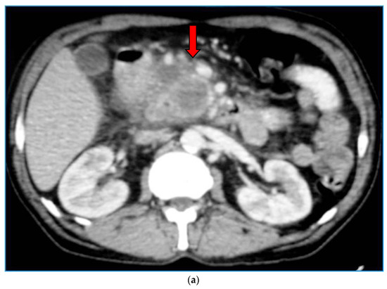 Intraductal Papillary Mucinous Neoplasm of the Pancreas: A Challenging ...