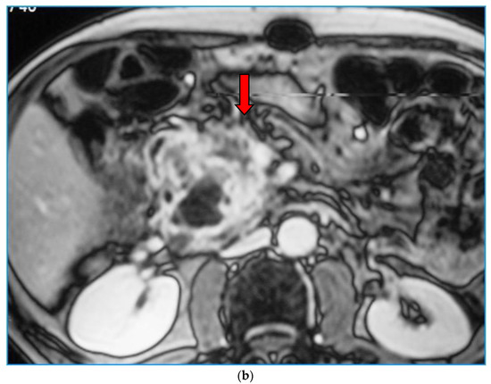Intraductal Papillary Mucinous Neoplasm of the Pancreas: A Challenging ...