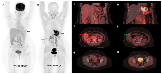 FAPI PET/CT Imaging—An Updated Review