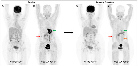 FAPI PET/CT Imaging—An Updated Review