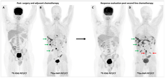 FAPI PET/CT Imaging—An Updated Review