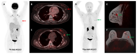 FAPI PET/CT Imaging—An Updated Review